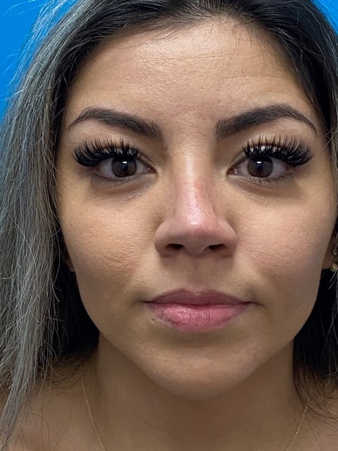 Before and After Photos Scottsdale, Arizona - Plastic Surgery Gallery ...