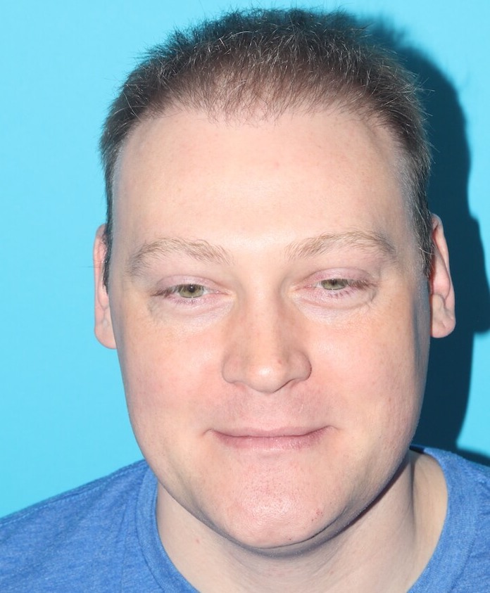 Before and After Photos Scottsdale, Arizona - Plastic Surgery Gallery ...