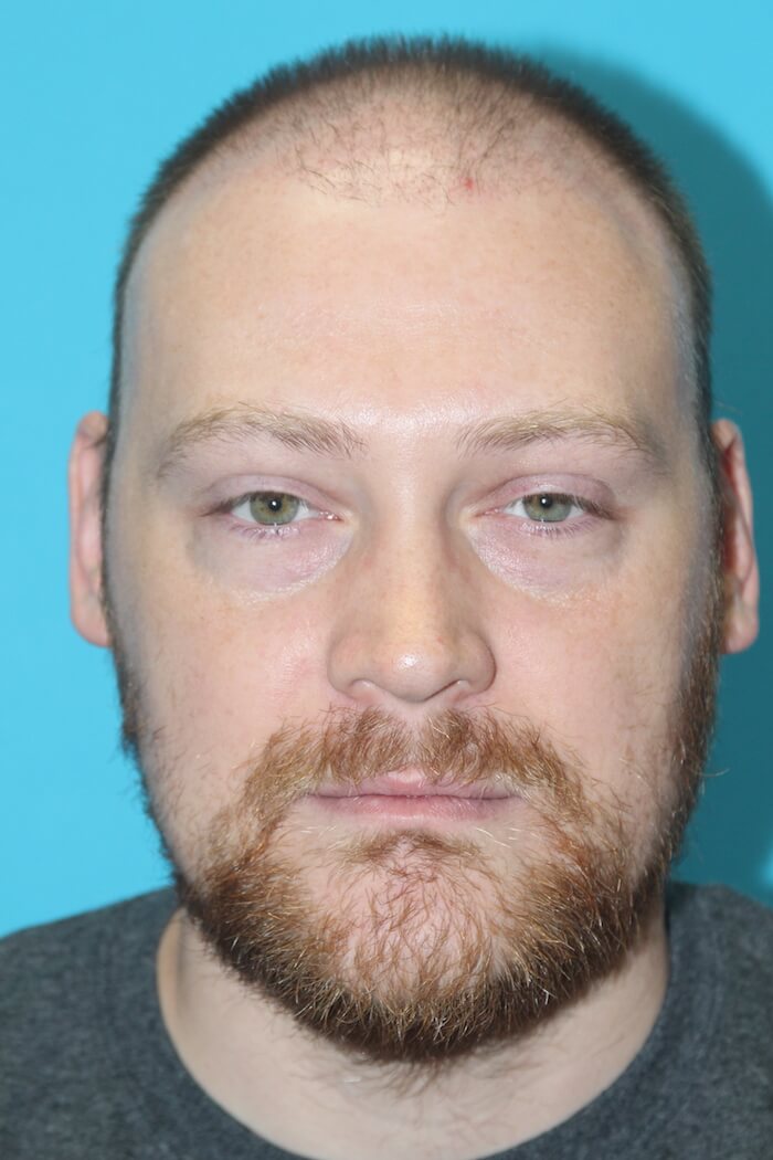 Before and After Photos Scottsdale, Arizona - Plastic Surgery Gallery ...