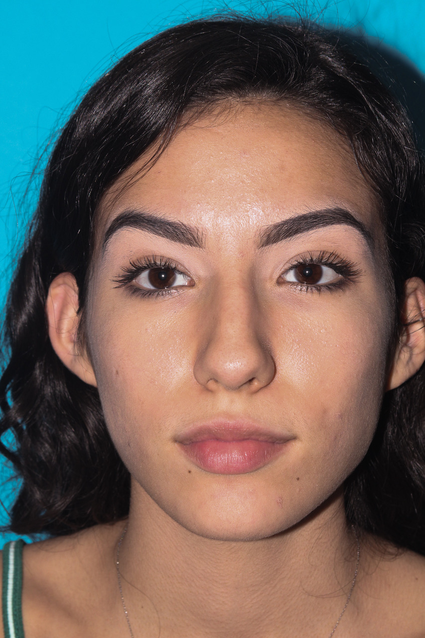 Before and After Photos Scottsdale, Arizona - Plastic Surgery Gallery ...