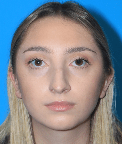 Before and After Photos Scottsdale, Arizona - Plastic Surgery Gallery ...