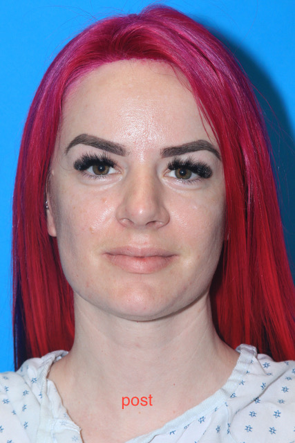 Before and After Photos Scottsdale, Arizona - Plastic Surgery Gallery ...