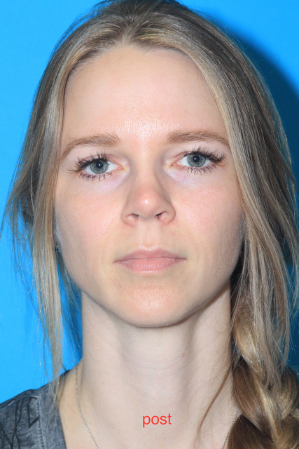 Before and After Photos Scottsdale, Arizona - Plastic Surgery Gallery ...