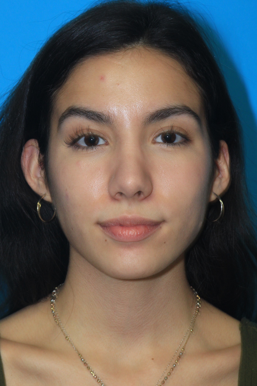 Before and After Photos Scottsdale, Arizona - Plastic Surgery Gallery ...