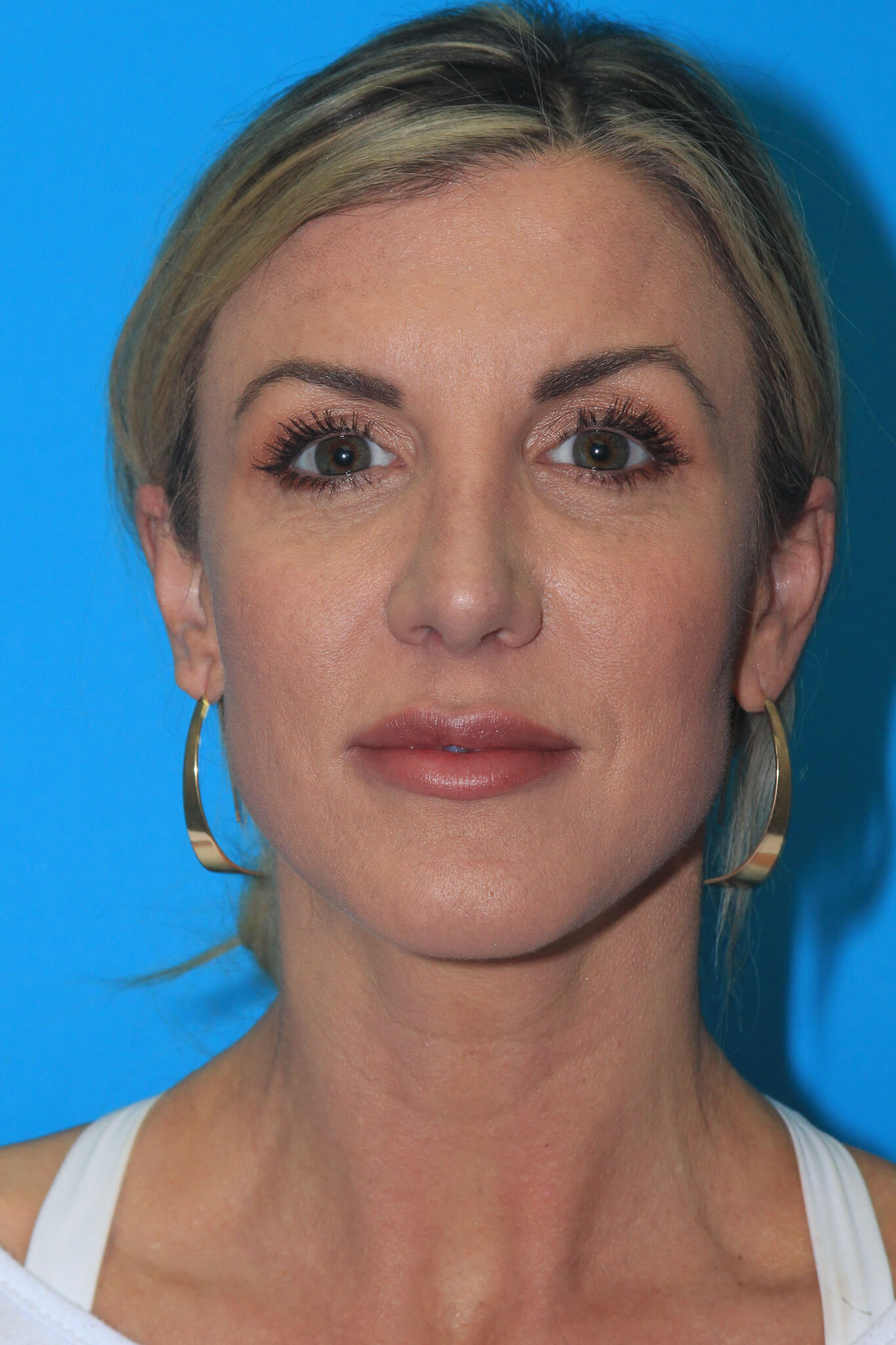 Before and After Photos Scottsdale, Arizona - Plastic Surgery Gallery ...