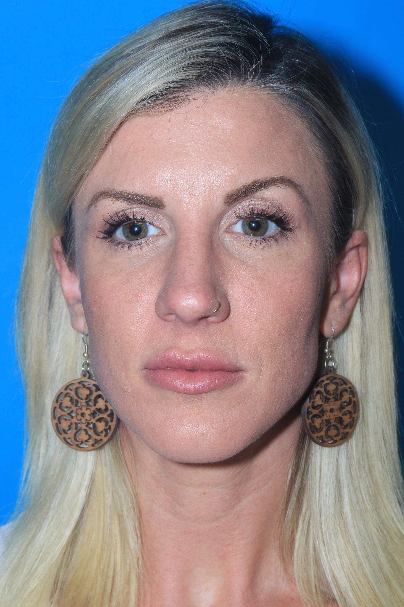 Before and After Photos Scottsdale, Arizona - Plastic Surgery Gallery ...